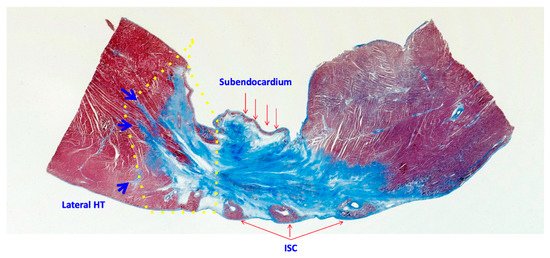Effects of Cardiac Stem Cell on Postinfarction Arrhythmogenic Substrate