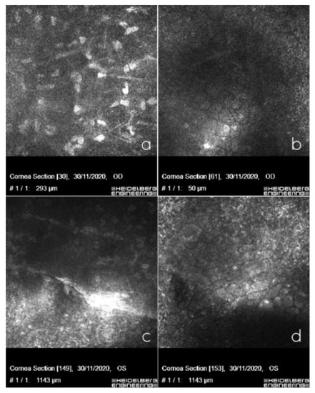 Posterior Polymorphous Corneal Dystrophy in a Patient with a Novel ZEB1 ...