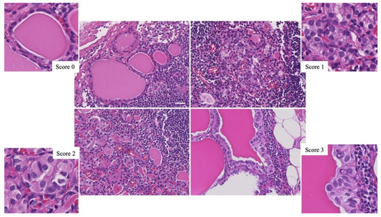 A New Indicator to Differentiate Thyroid Follicular Inclusions in Cervical Lymph Nodes from ...