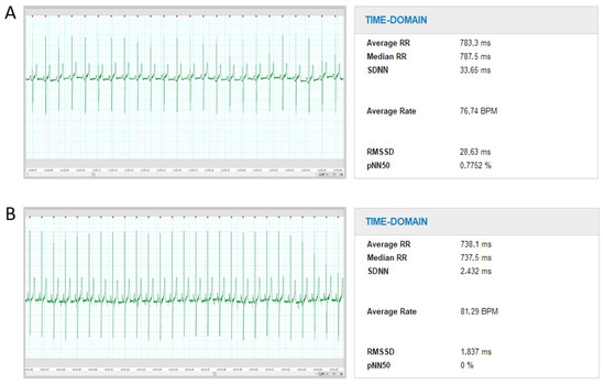 IJMS | Free Full-Text | Acute Severe Heart Failure Reduces Heart Rate ...