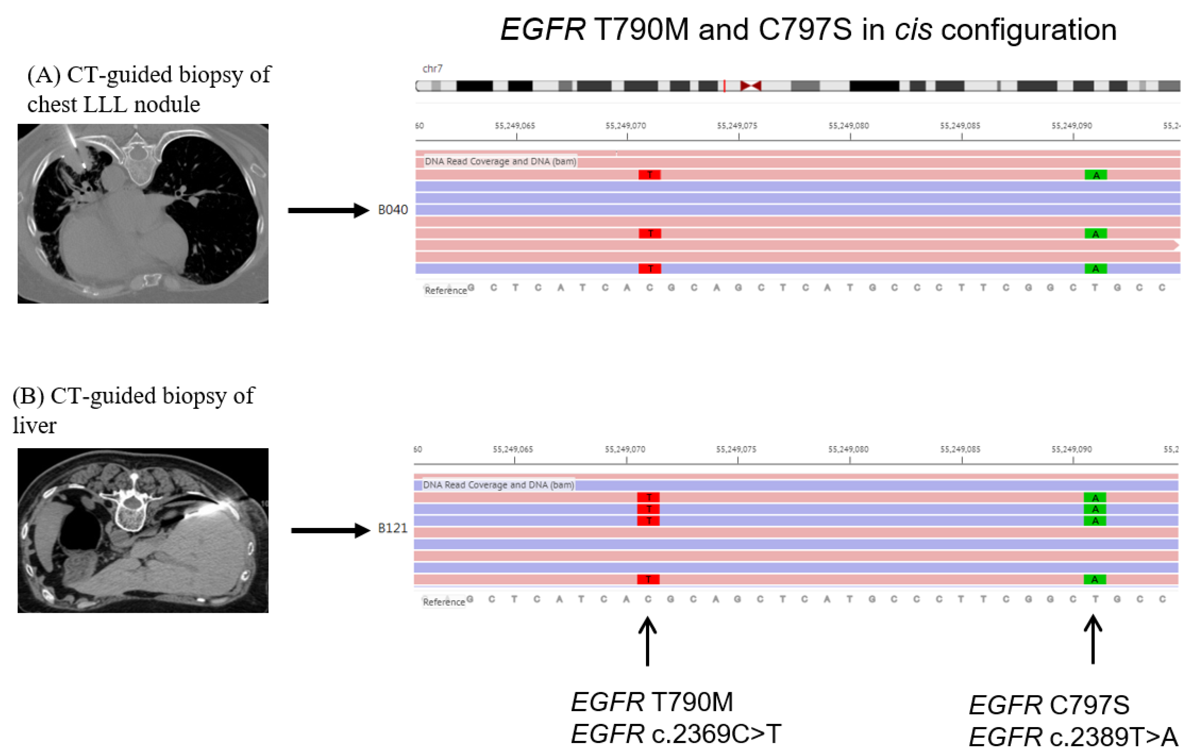 Response to Brigatinib Targeted Therapy in Non-Small Cell Lung Cancer ...