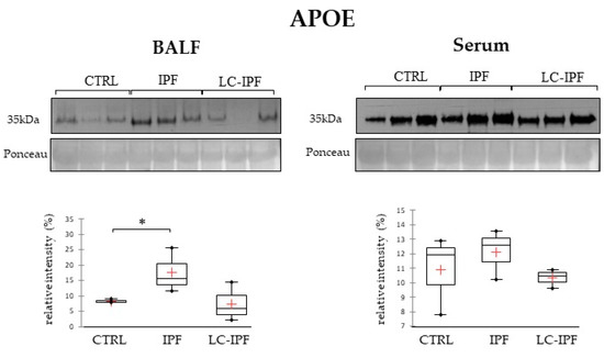 IJMS | Free Full-Text | BAL Proteomic Signature of Lung Adenocarcinoma ...