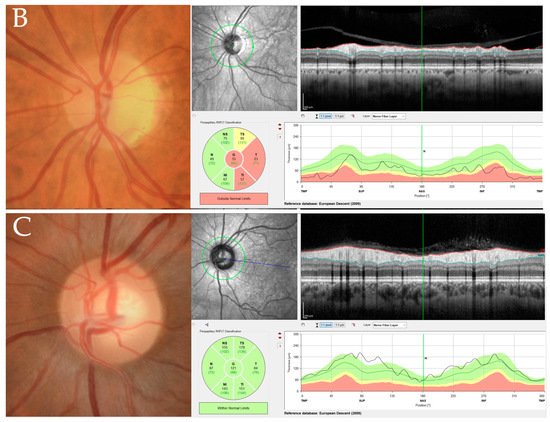 IJMS | Free Full-Text | Optic Nerve Structural and Functional Changes ...