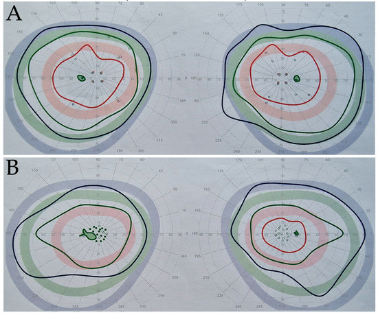 IJMS | Free Full-Text | Optic Nerve Structural and Functional Changes ...