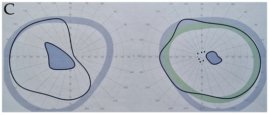 IJMS | Free Full-Text | Optic Nerve Structural and Functional Changes ...