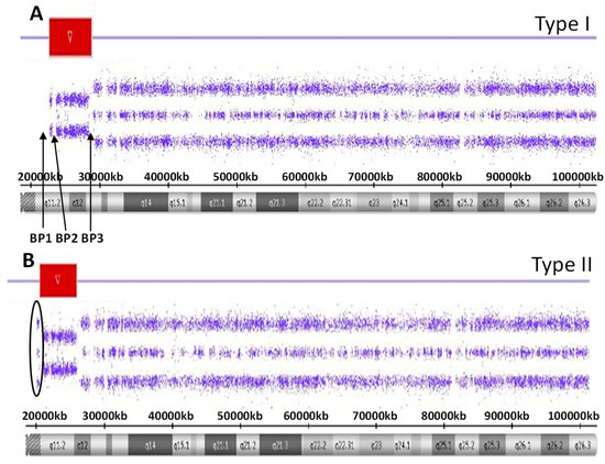 Chromosomal Microarray Study in Prader-Willi Syndrome