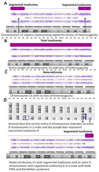 Chromosomal Microarray Study in Prader-Willi Syndrome