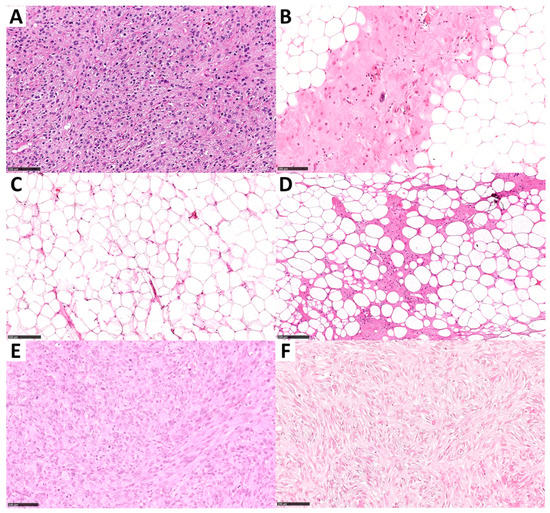 FISH Diagnostic Assessment of MDM2 Amplification in Liposarcoma ...