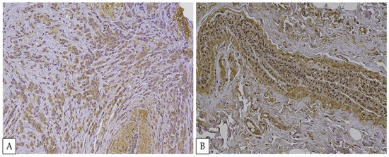 FOXO3 Depletion as a Marker of Compression-Induced Apoptosis in the ...