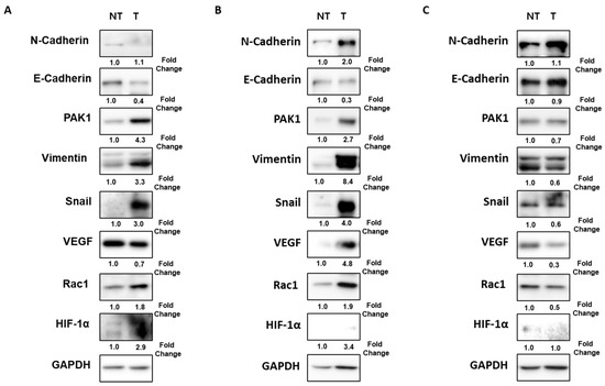 Clinical Significance of Combined Epithelial–Mesenchymal Transition ...