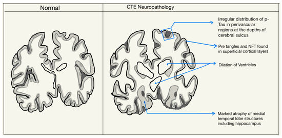 Understanding the Molecular Progression of Chronic Traumatic ...