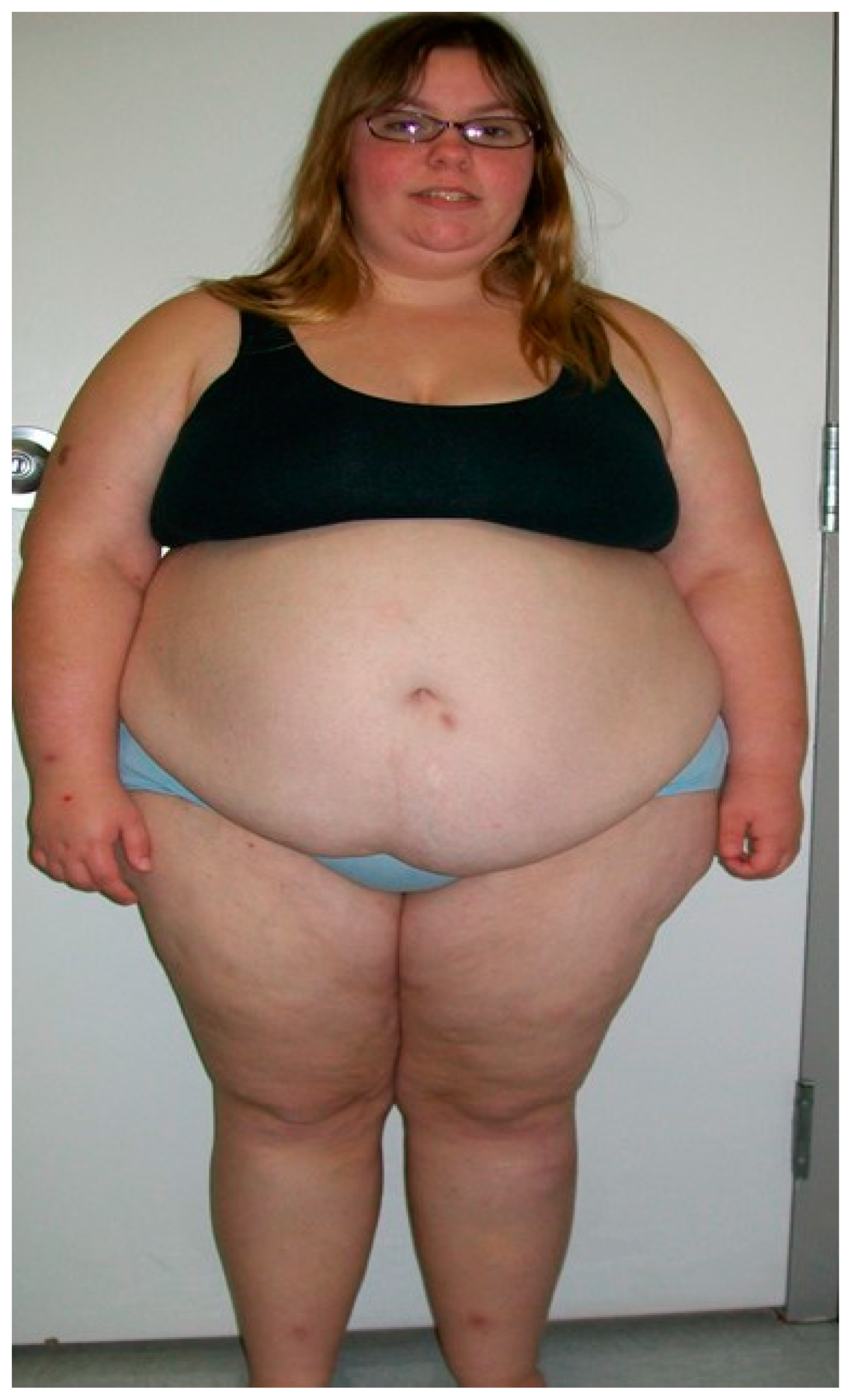 Mild Prader Willi Syndrome