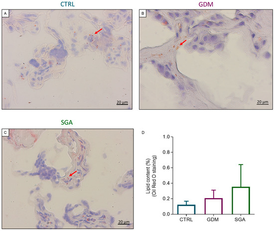 Gestational Diabetes Mellitus and Small-for-Gestational-Age: An Insight ...