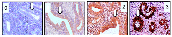 RPLP1 Is Up-Regulated in Human Adenomyosis and Endometrial ...