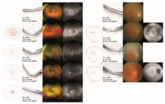 Biallelic Variants in TULP1 Are Associated with Heterogeneous ...