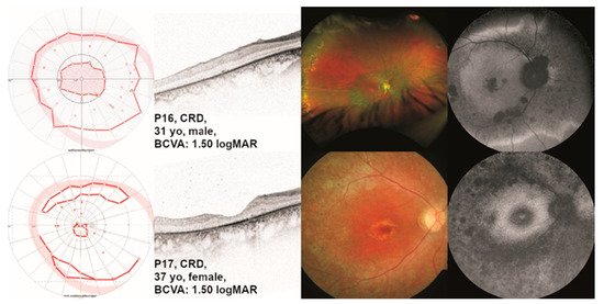 Biallelic Variants in TULP1 Are Associated with Heterogeneous ...