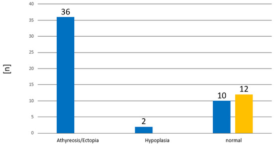 Prevalence of Transient Hypothyroidism in Children Diagnosed with ...