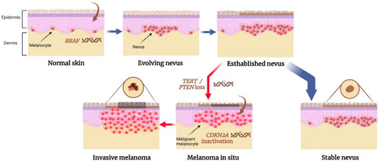 IJMS | Free Full-Text | The Complex Interplay between Nevi and Melanoma ...