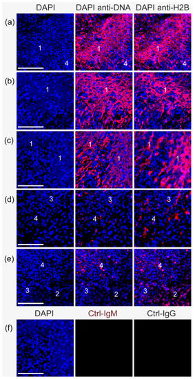 Anti-DNA-IgM Favors the Detection of NET-Associated Extracellular DNA