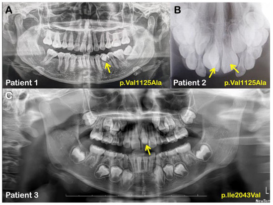 Supernumerary Teeth Xray
