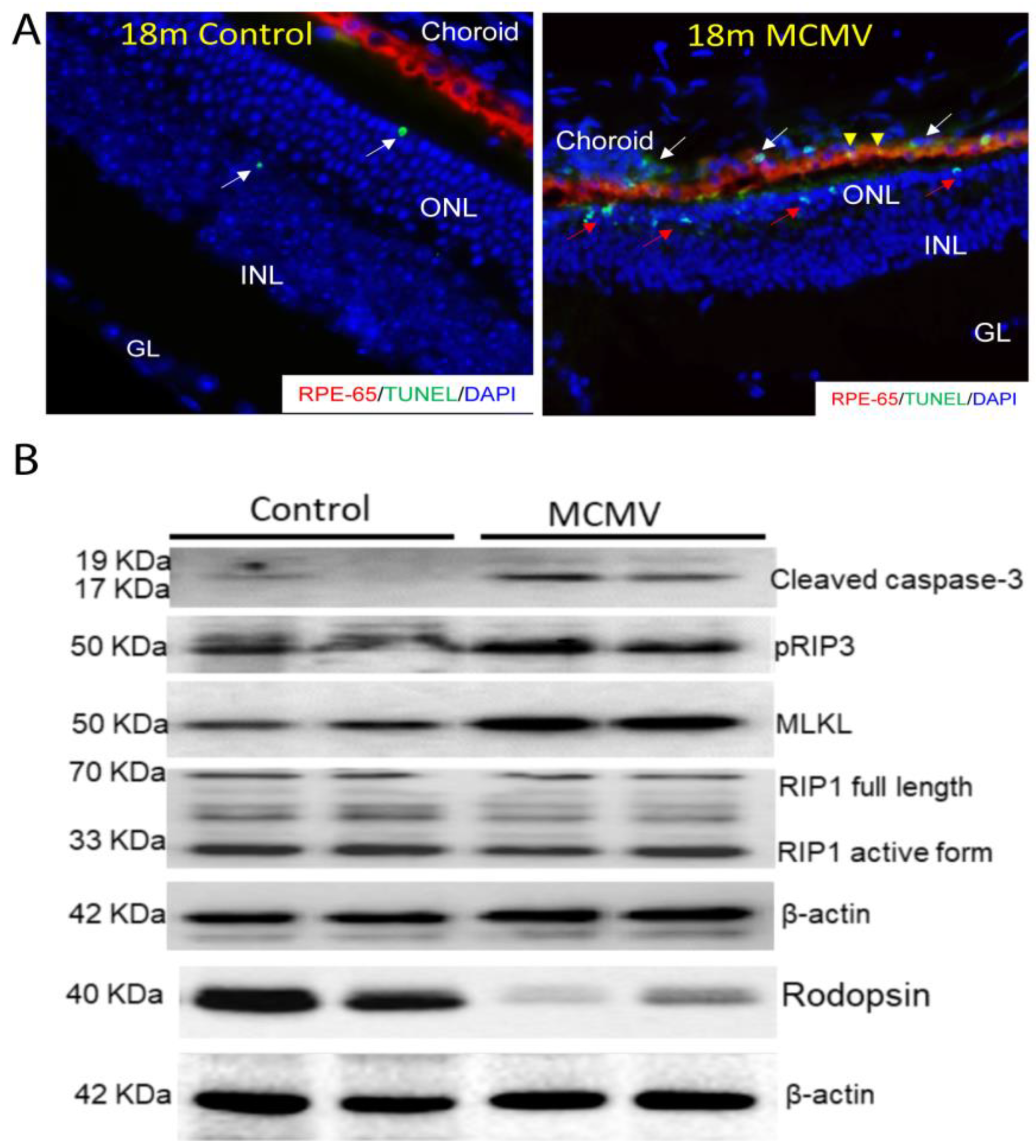 Transcriptome Analysis of Retinal and Choroidal Pathologies in Aged ...