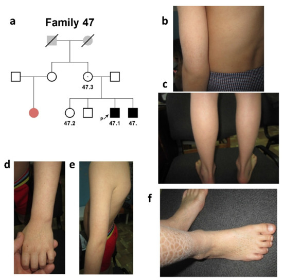 Genetic Heterogeneity of X-Linked Ichthyosis in the Republic of North ...