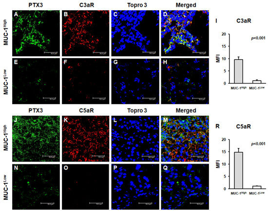 MUC1 Expression Affects the Immunoflogosis in Renal Cell Carcinoma ...
