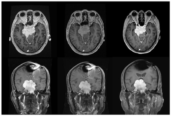 Advances in Boron Neutron Capture Therapy (BNCT) for Recurrent Intracranial Meningioma