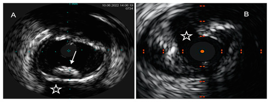 Intracoronary Imaging of Coronary Atherosclerotic Plaque: From ...