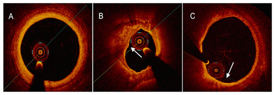 Intracoronary Imaging of Coronary Atherosclerotic Plaque: From ...