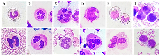 Leucocyte Abnormalities in Synovial Fluid of Degenerative and ...