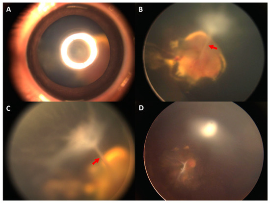 Retrospective Analysis of Surgical Outcomes on Axial Length Elongation ...