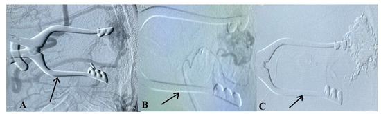 An Uncommon Case of Moyamoya Syndrome Is Accompanied by an ...