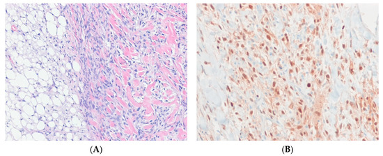 The Recent Advances in Molecular Diagnosis of Soft Tissue Tumors