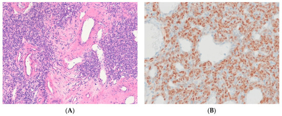 The Recent Advances in Molecular Diagnosis of Soft Tissue Tumors