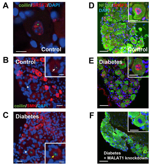 Diabetic Polyneuropathy: New Strategies to Target Sensory Neurons in ...