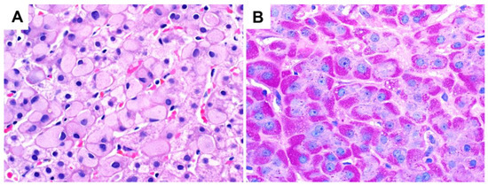 The Liver and Glycogen: In Sickness and in Health