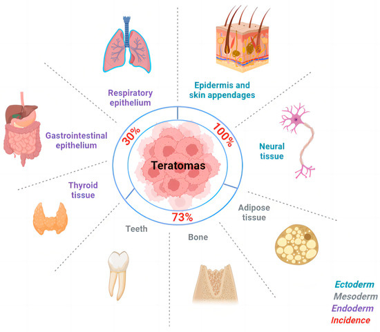 IJMS | Free Full-Text | Mature Cystic Teratoma: An Integrated Review