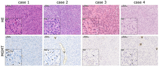 Influence of MMR, MGMT Promotor Methylation and Protein Expression on ...