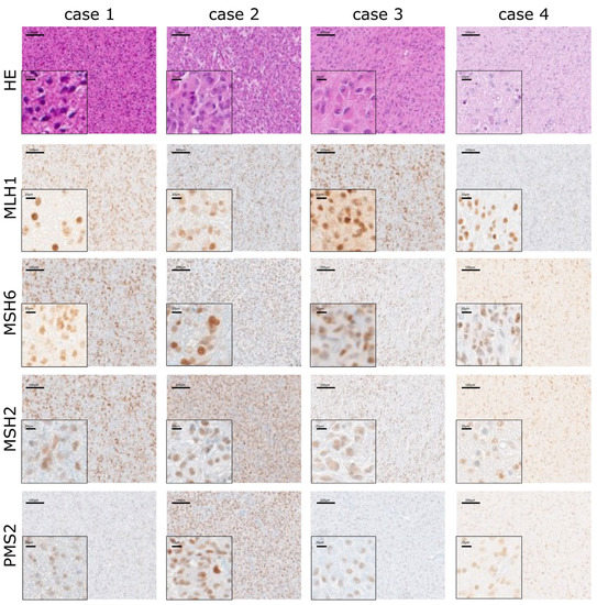 Influence of MMR, MGMT Promotor Methylation and Protein Expression on ...