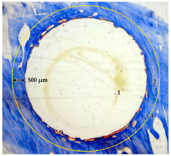 Histological and Histomorphometric Evaluation of Implanted Photodynamic ...