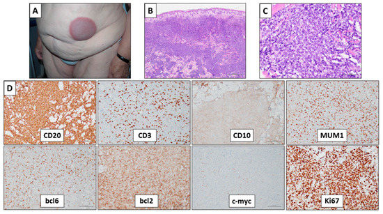 Primary Cutaneous B-Cell Lymphomas with Large Cell Morphology: A Practical Review