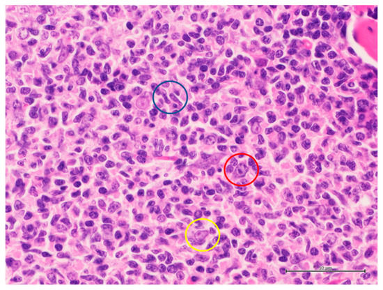 IJMS | Free Full-Text | Primary Cutaneous B-Cell Lymphomas with Large Cell Morphology: A ...