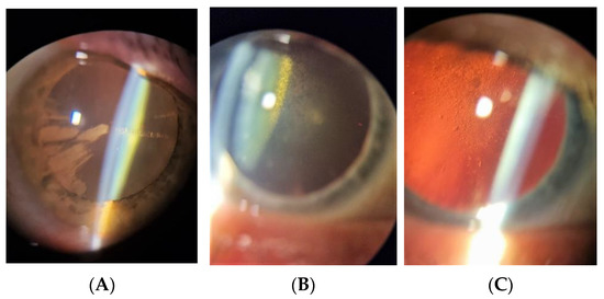 Current Approach to the Pathogenesis of Diabetic Cataracts