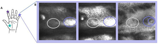 Revealing the Meissner Corpuscles in Human Glabrous Skin Using In Vivo ...