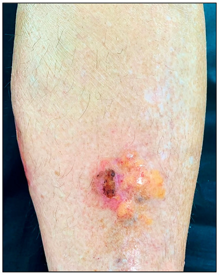 IJMS | Free Full-Text | Localized Cutaneous Nodular Amyloidosis: A ...