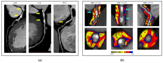 Elevated FAI Index of Pericoronary Inflammation on Coronary CT ...