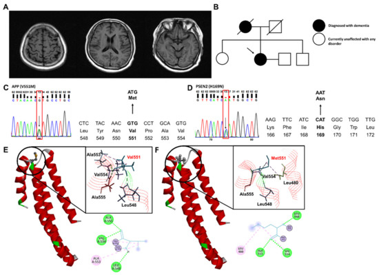 Double Mutations in a Patient with Early-Onset Alzheimer’s Disease in ...