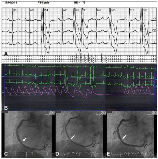 IJMS | Free Full-Text | Coronary Artery Spasm-Related Heart Failure ...