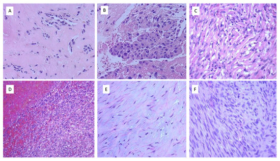 Intimal Sarcoma with MDM2/CDK4 Amplification and p16 Overexpression: A ...